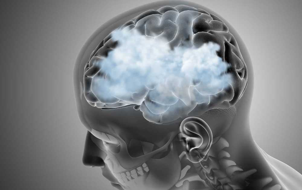 Brain Fog hingga Kejang pada Pasien Lupus: Mengenal Neuropsychiatric ...